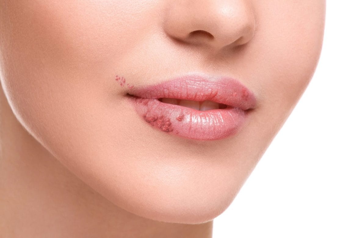 Dermatite: O que é, quais os tipos, sintomas, como evitar? | Farmadelivery