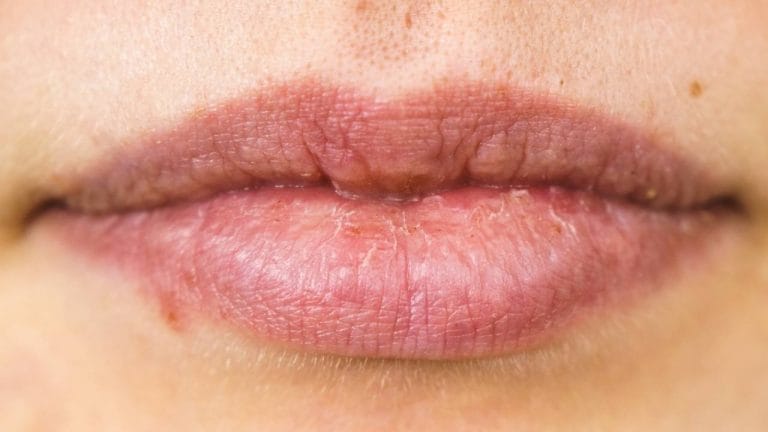 Queilite: O que é, causas, prevenção e tipos de tratamento. |Farmadelivery